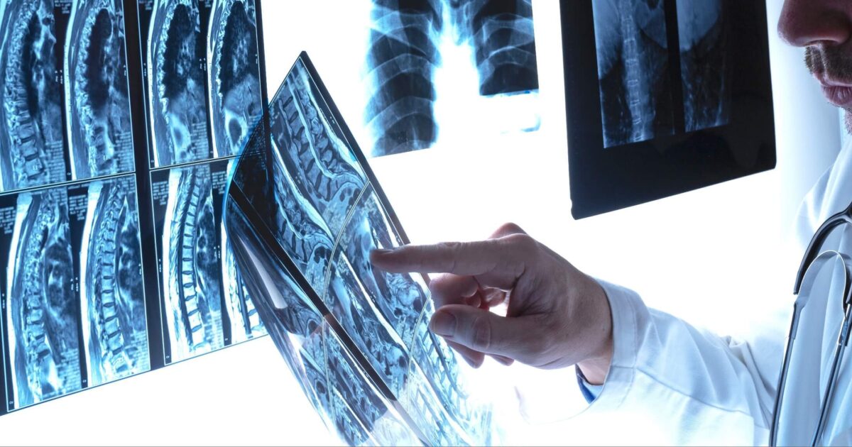 Delayed Treatment of Spinal Stenosis – Mr S | Case Study